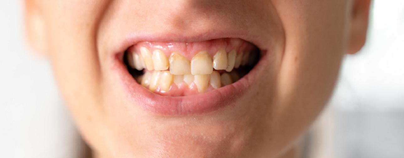 Help: ik schaam me voor mijn gebit – Startpagina Blog