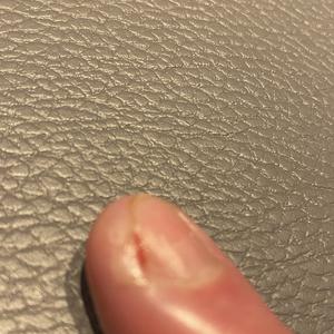 Wat kan ik doen bij ontstoken vinger? - GoeieVraag