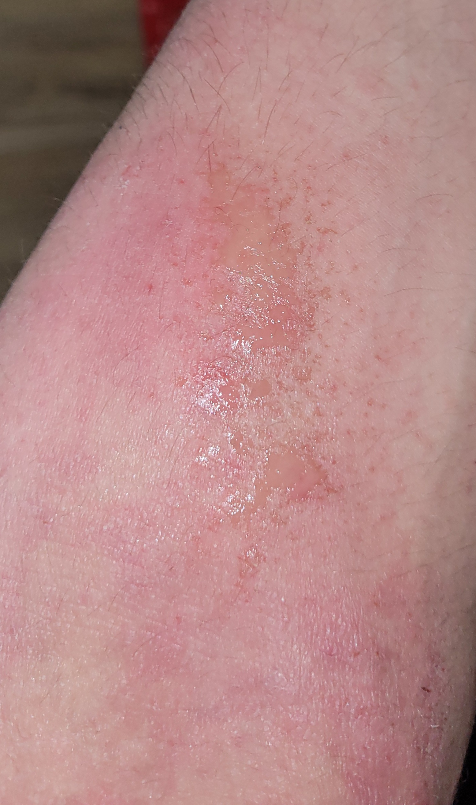 Wat is dit voor vochtige wond? - GoeieVraag